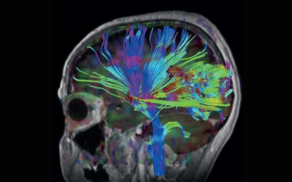 fMRI Guided TMS with SAINT® | Restorative Imaging Institute